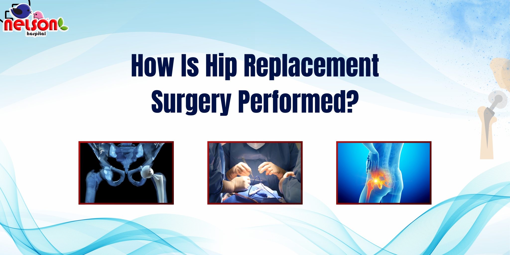 Hip Replacement Surgery | Nelson Hospital
